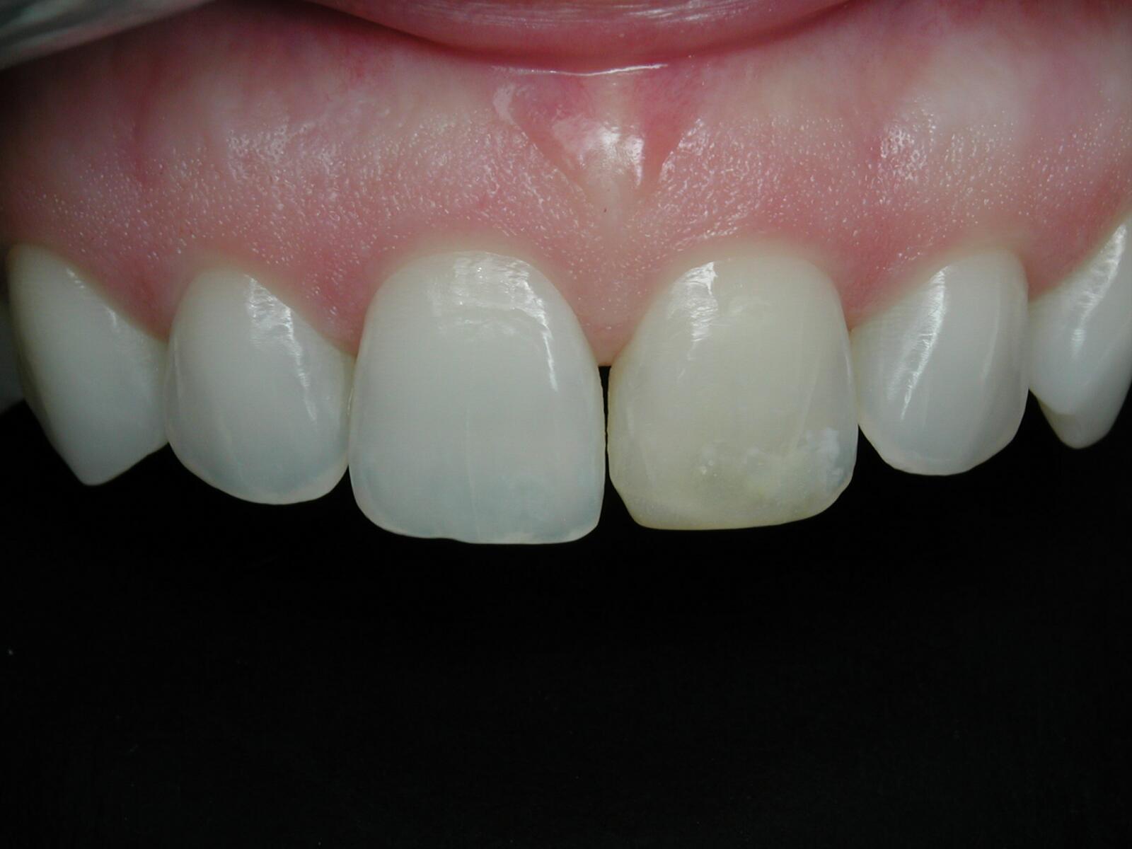 Smile Gallery | Schaefer Advanced Dentistry
