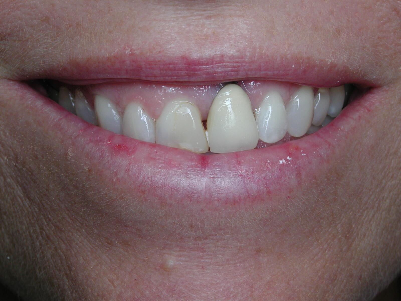 Smile Gallery | Schaefer Advanced Dentistry